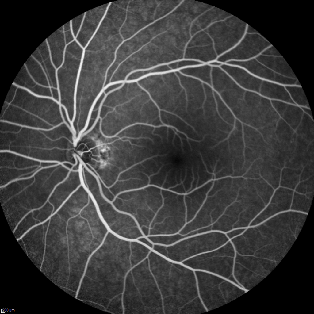 Angiographie - Centre Ophtalmologique Odéon